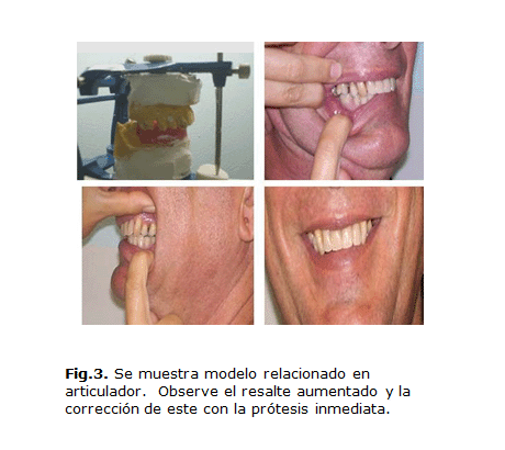 Importancia estética de la prótesis inmediata | Vinent Céspedes | MEDISAN