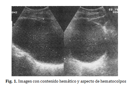 Hematocolpos por himen imperforado en una adolescente | Hernández Dinza ...